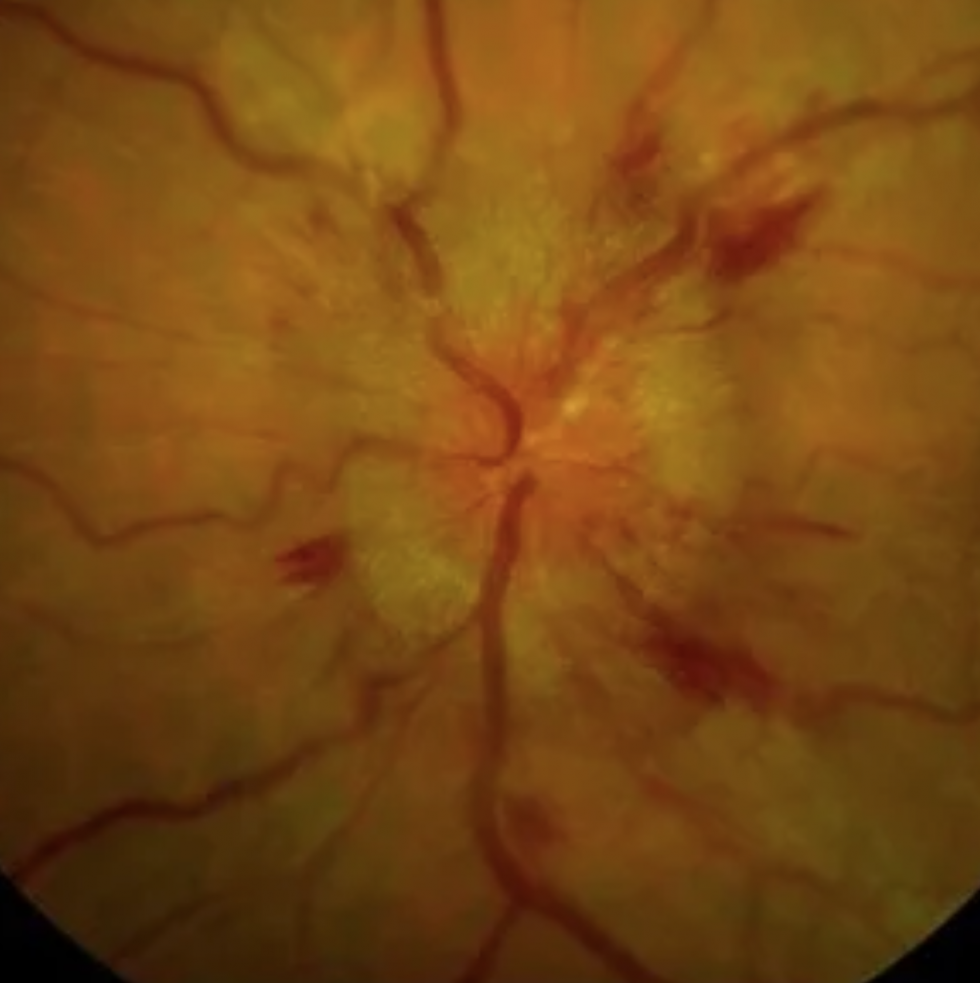 ¿Qué es la neuritis óptica? | Oftalmología Humanista